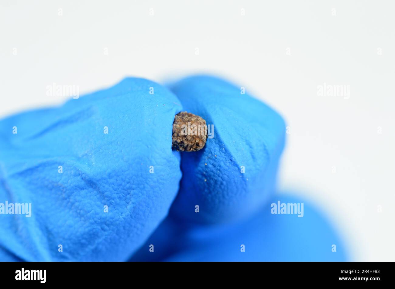 Nefrolitiasi, calcoli renali marroni irregolari (calcoli renali o ...