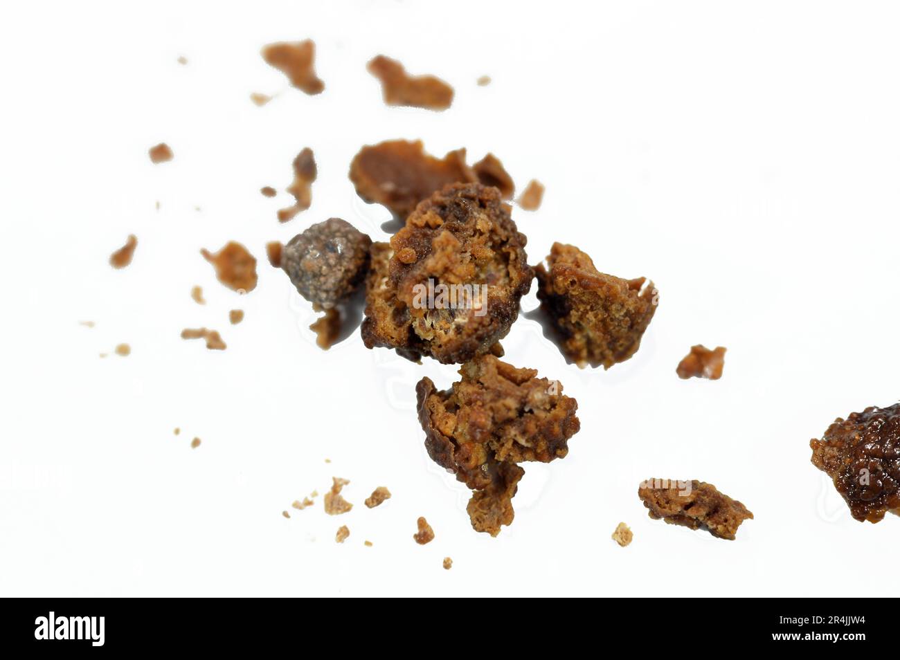 Nefrolitiasi, calcoli renali marroni irregolari (calcoli renali o ...