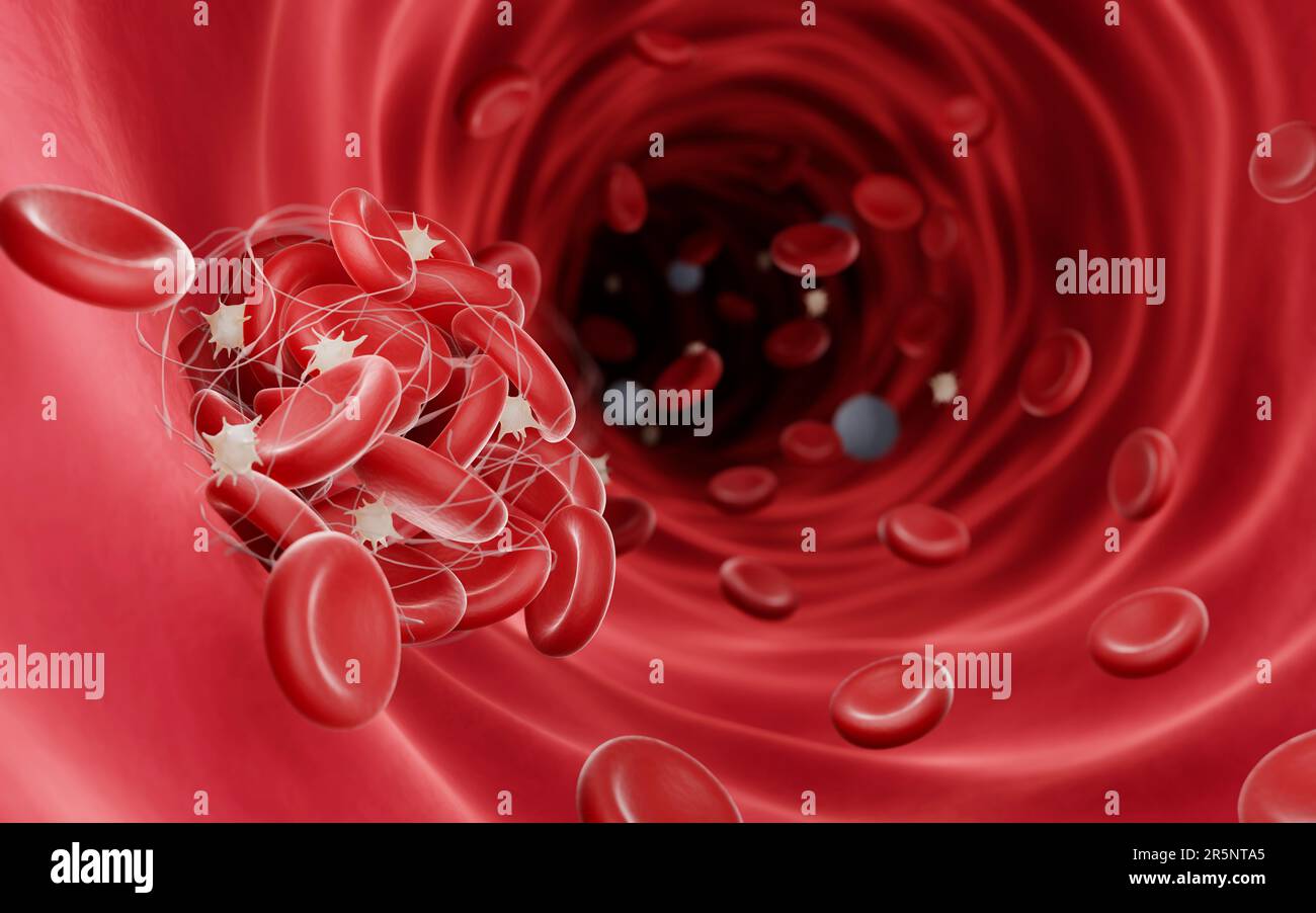 Deep vein thrombosis immagini e fotografie stock ad alta risoluzione ...