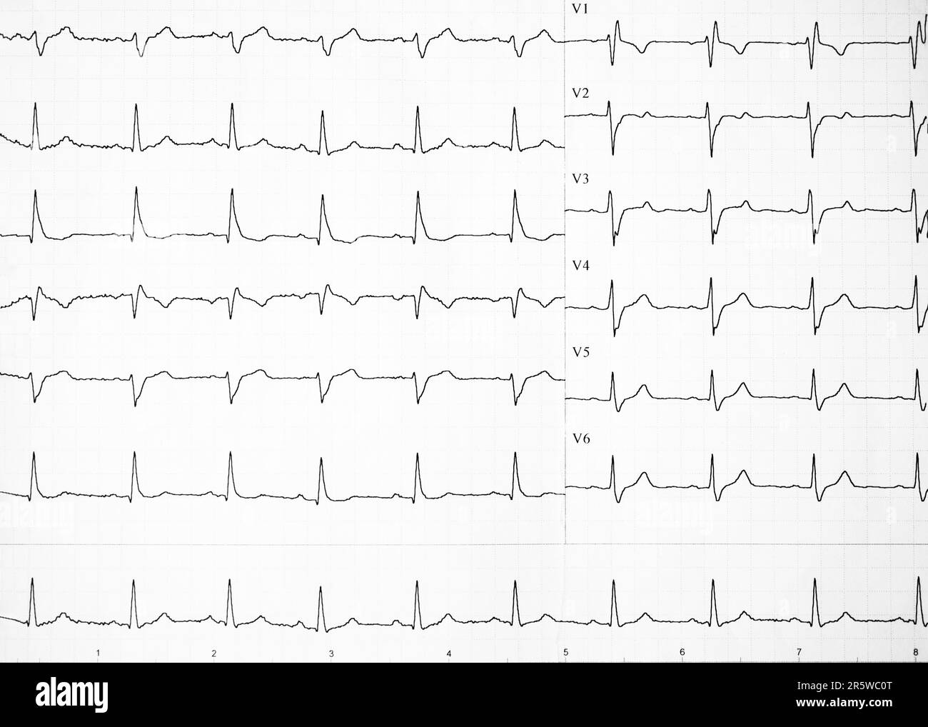 Carta de electrocardiograma Foto e Immagini Stock in Bianco e Nero - Alamy