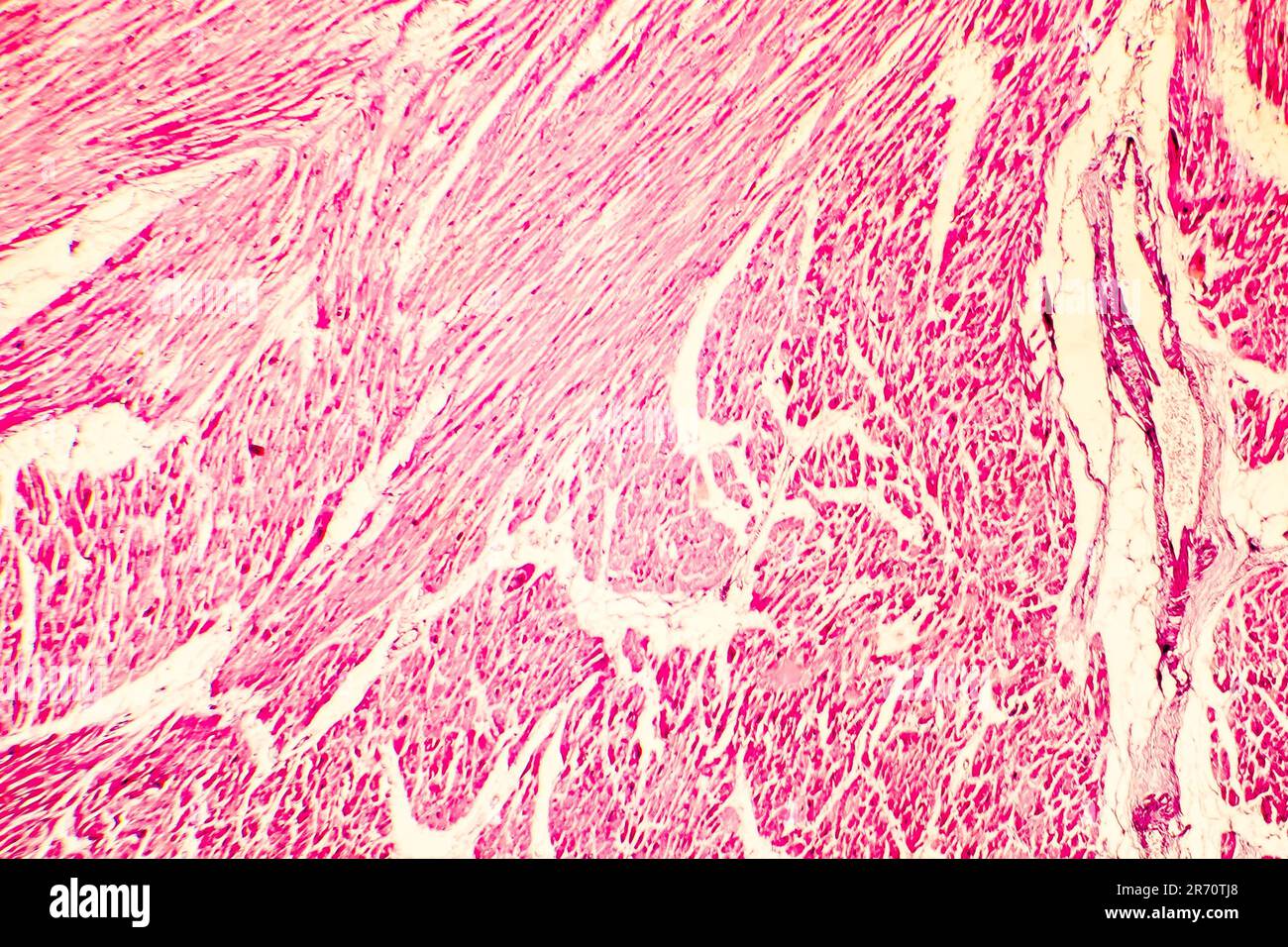 Ipertrofia cardiaca. Fotomicrografia che mostra miocardio ipertrofico ...