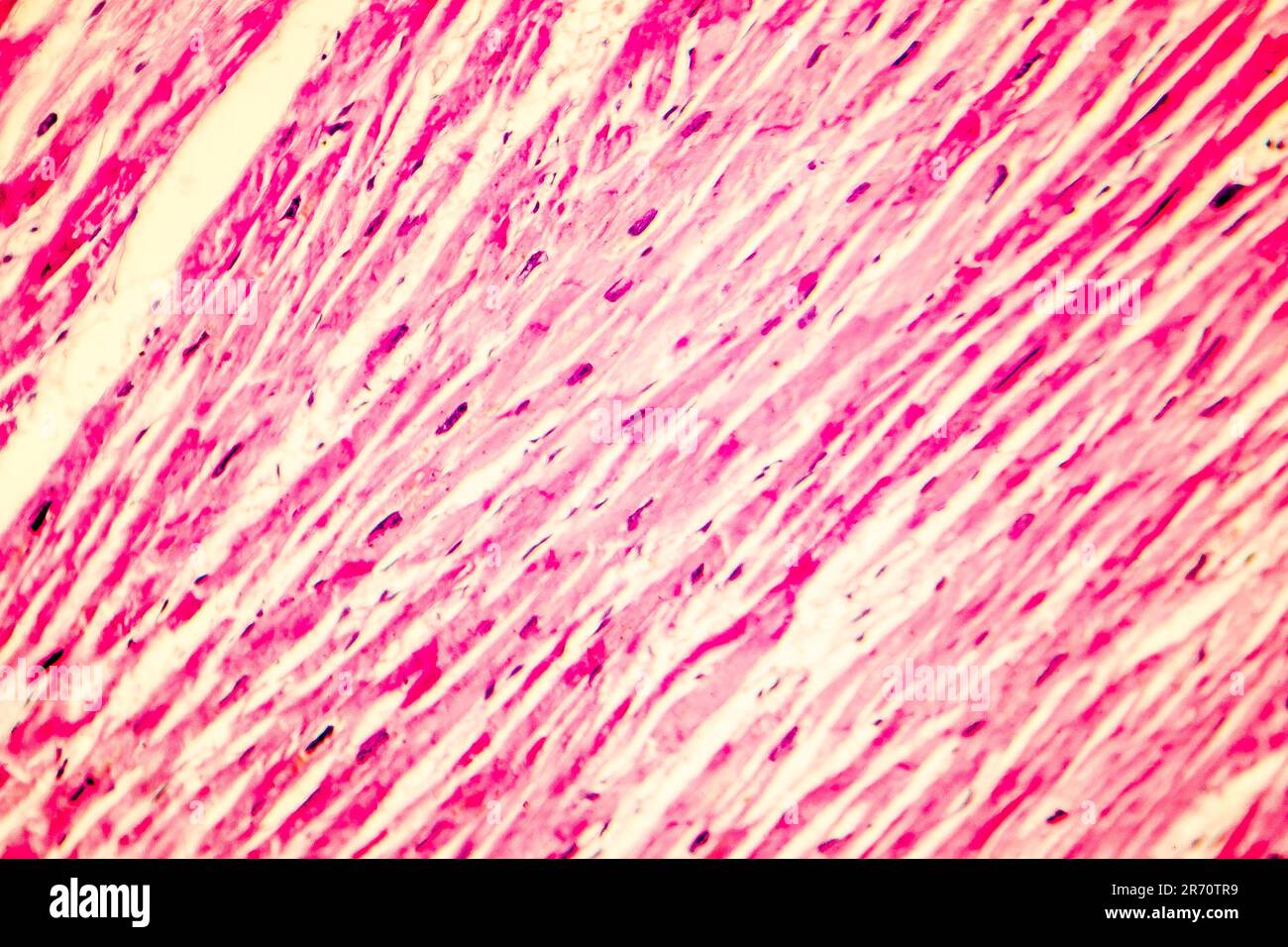 Ipertrofia cardiaca. Fotomicrografia che mostra miocardio ipertrofico ...
