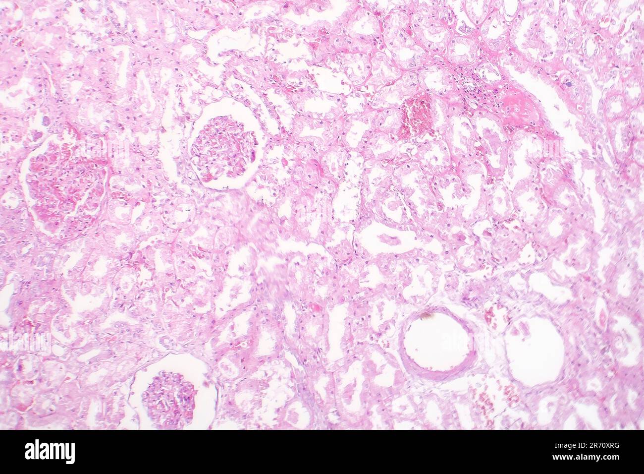Edema epiteliale tubolare, micrografia leggera, foto al microscopio ...