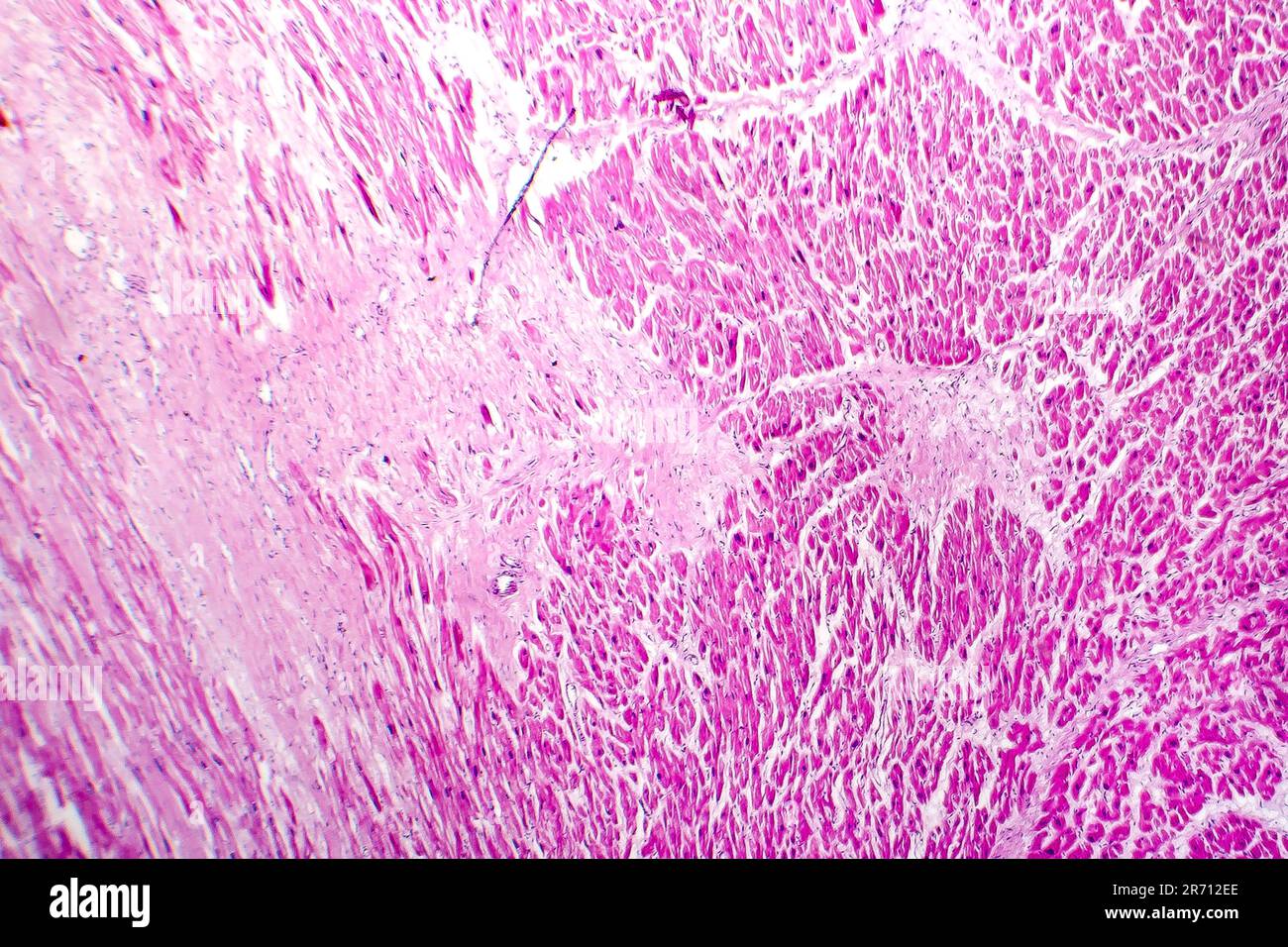 Infarto miocardico acuto, istologia del tessuto cardiaco, micrografia ...