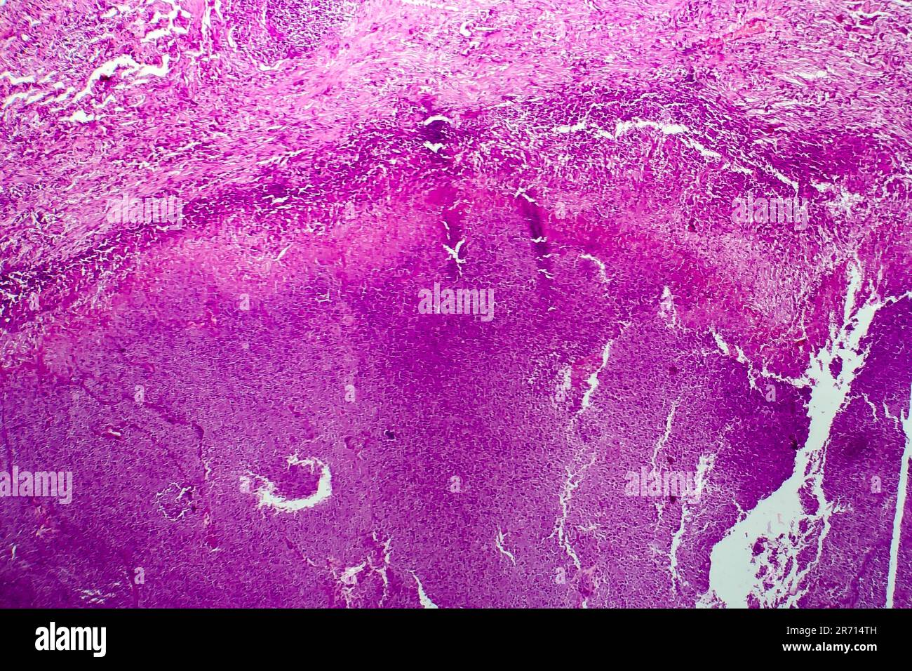 Caseazione di granuloma di tubercolosi umana, micrografia leggera, foto ...