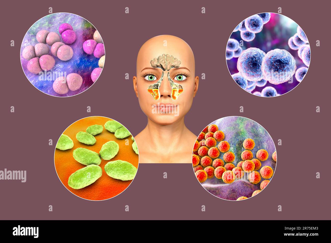 Anatomia della rinosinusite e dei batteri che causano la sinusite ...
