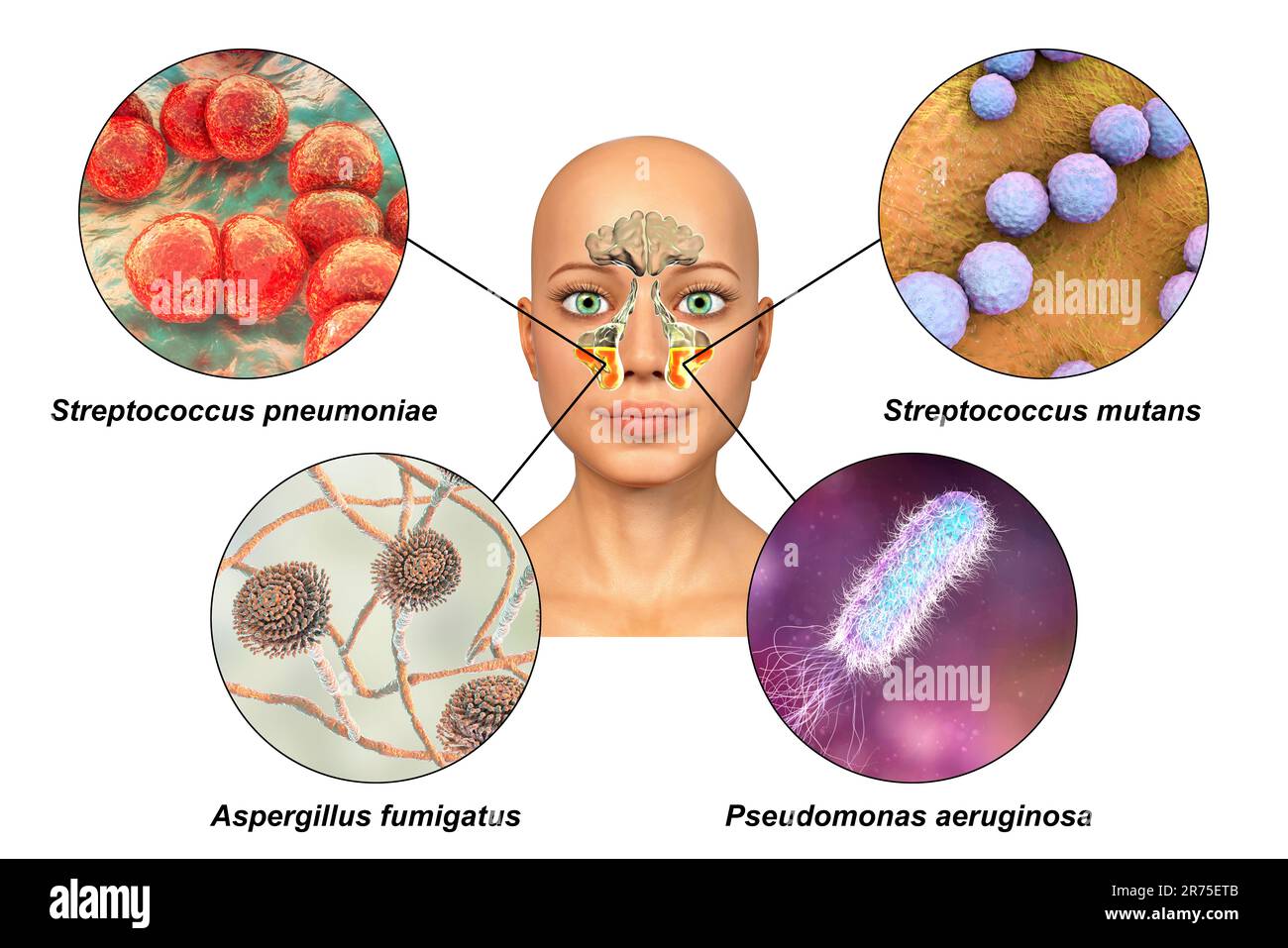 Anatomia della rinosinusite e microrganismi che causano sinusite ...