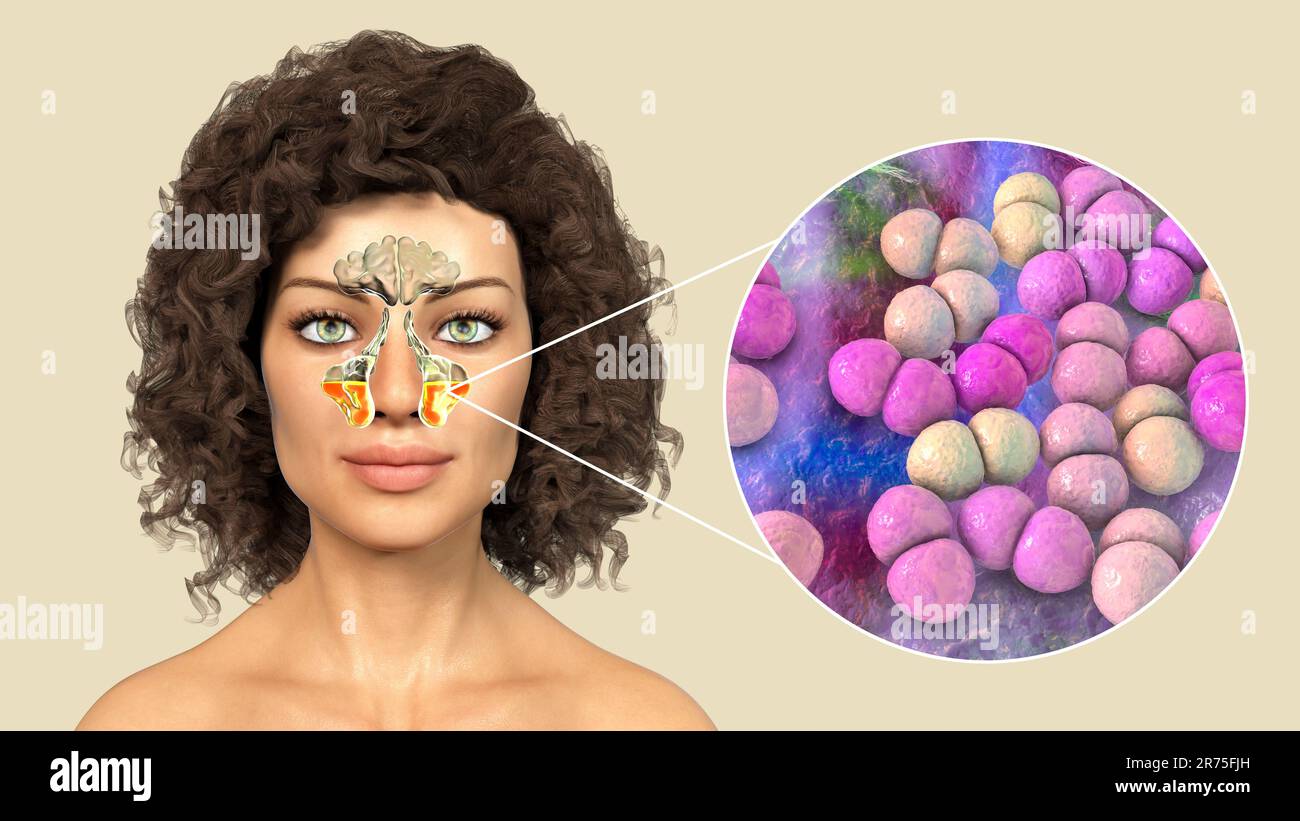 I batteri Streptococcus pneumoniae come causa di sinusite ...