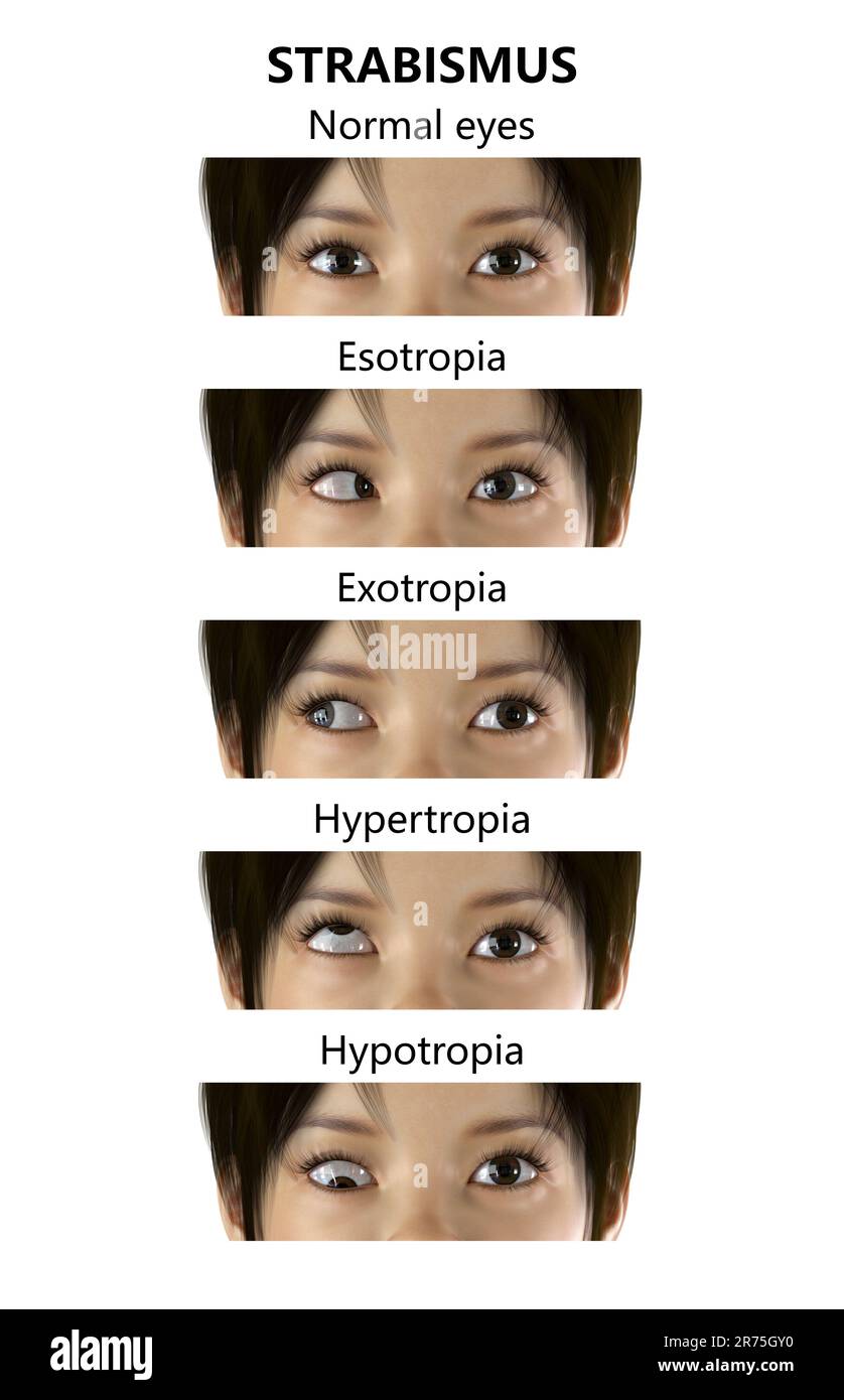Strabismo verso l'alto immagini e fotografie stock ad alta risoluzione ...