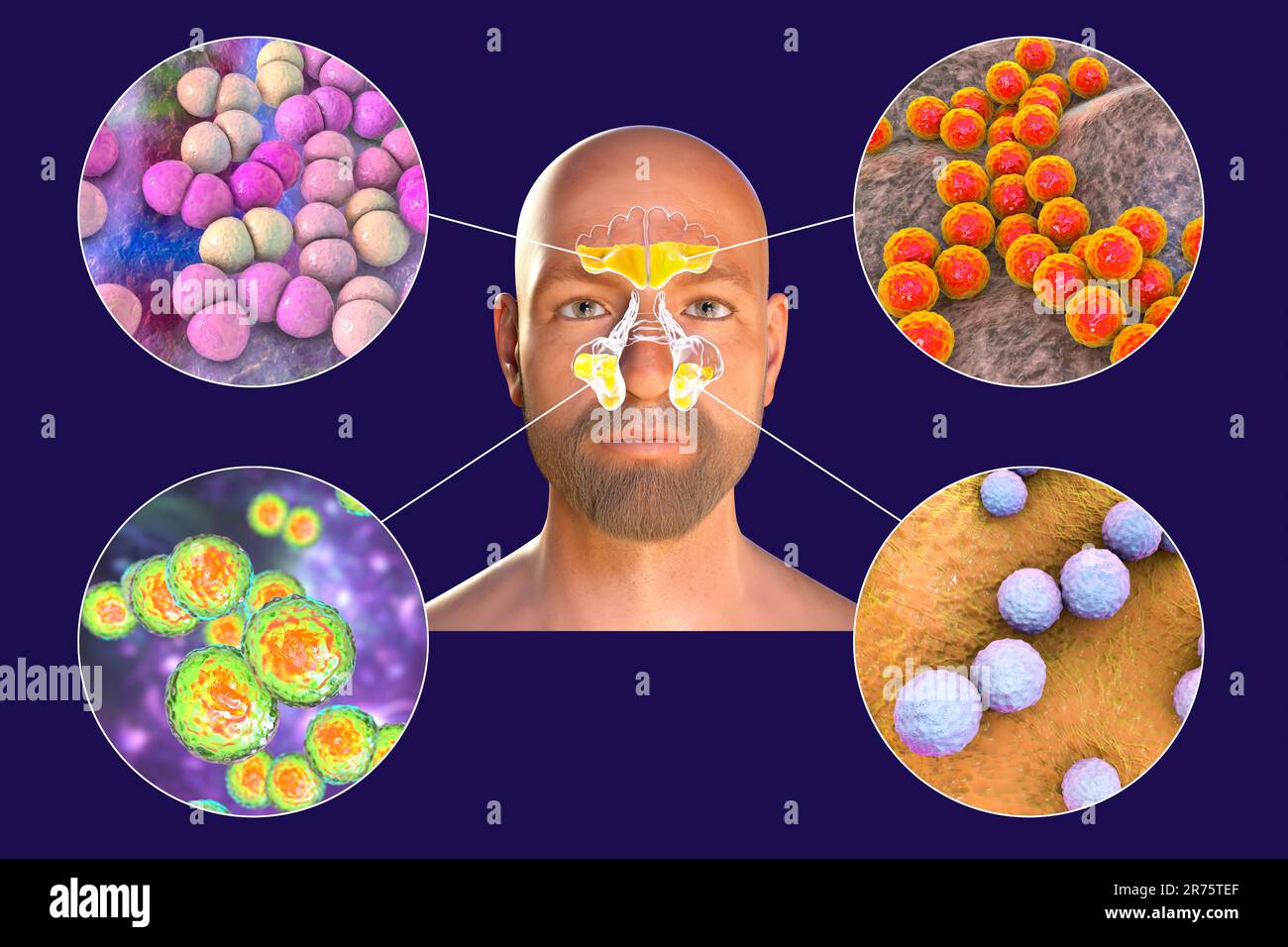 Rinosinusite in un uomo e batteri che causano sinusite. Streptococcus ...