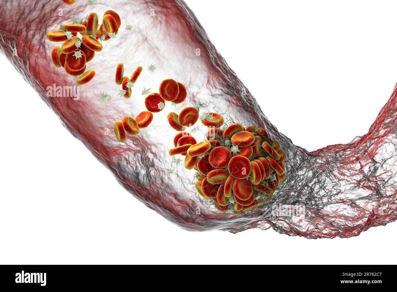 Rischio di coaguli di sangue da coronavirus immagini e fotografie stock ...