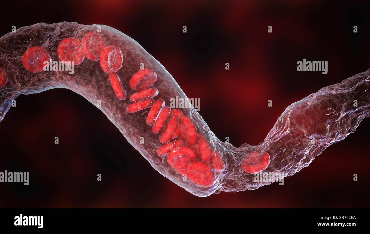 Rischio di coaguli di sangue da coronavirus immagini e fotografie stock ...