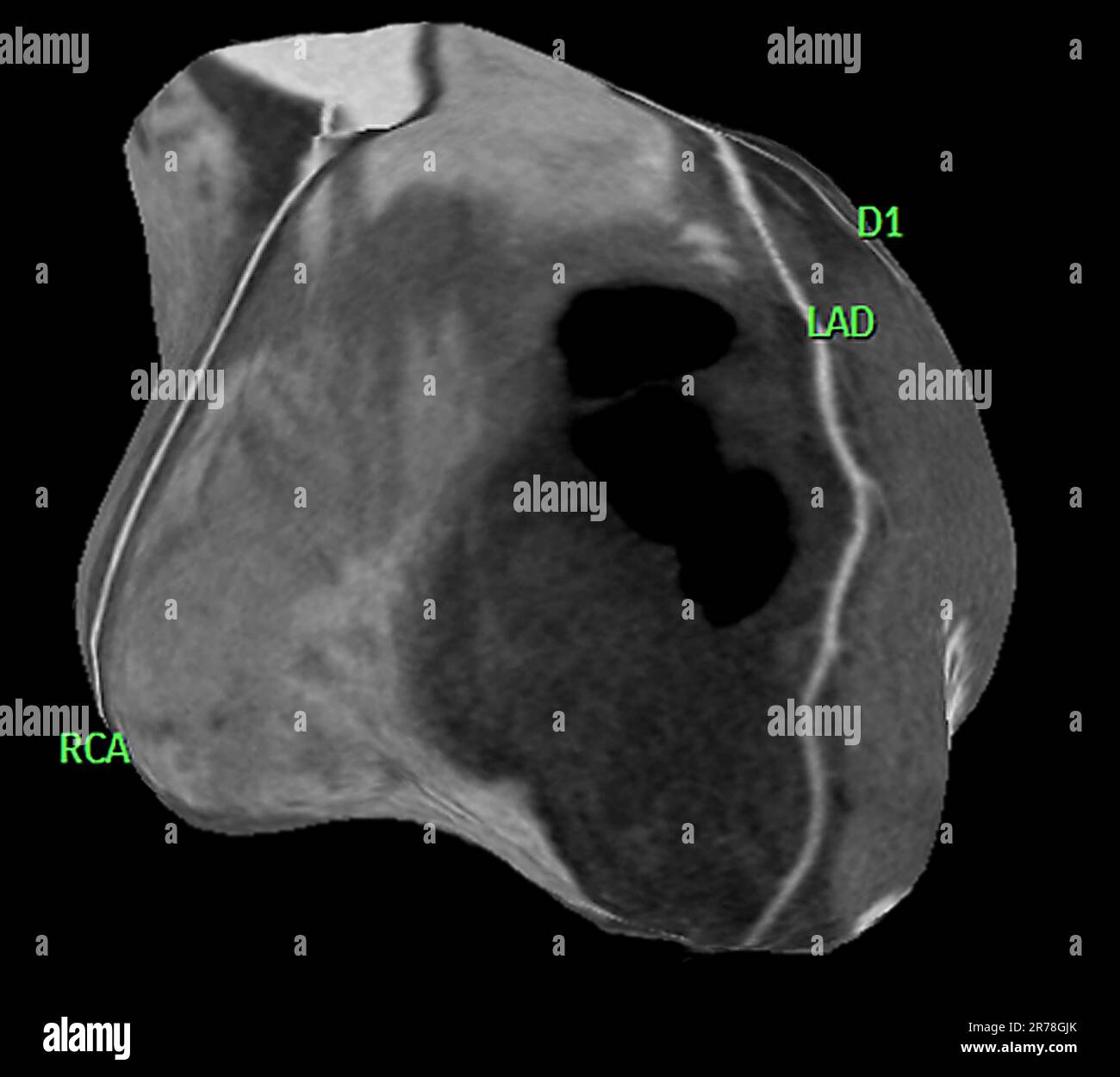 3D tomografia computerizzata (TC) scansione angiografica del cuore di ...