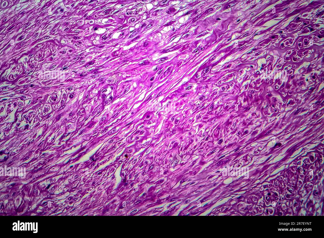 Fibroide uterino. Micrografia di luce (LM) di una sezione attraverso il ...