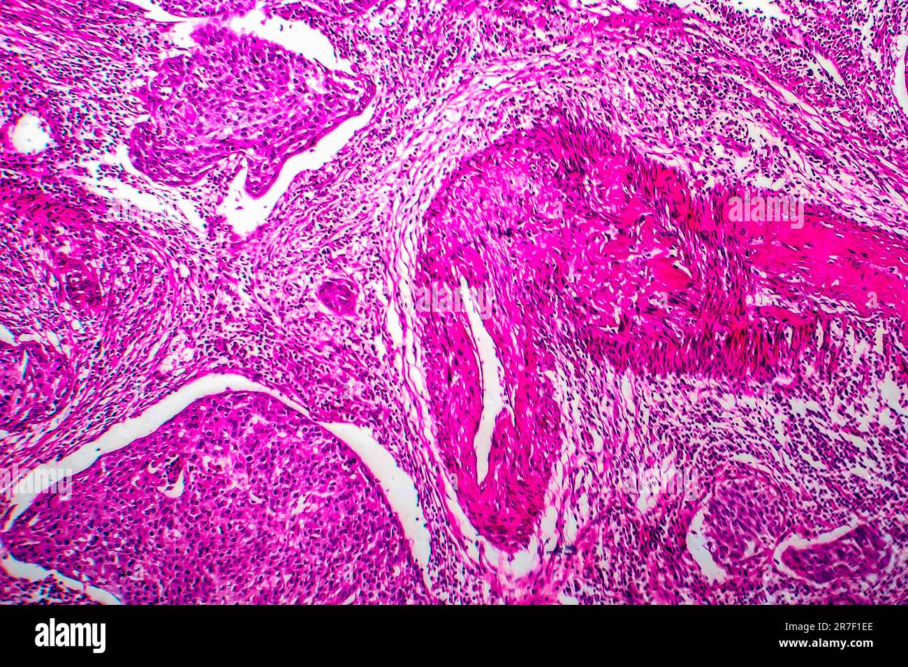 Il cancro cervicale. Micrografia di luce (LM) di una sezione di un ...