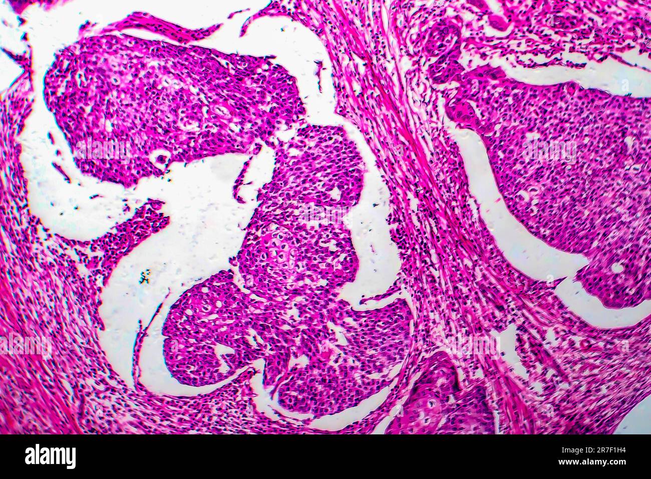 Il cancro cervicale. Micrografia di luce (LM) di una sezione di un ...