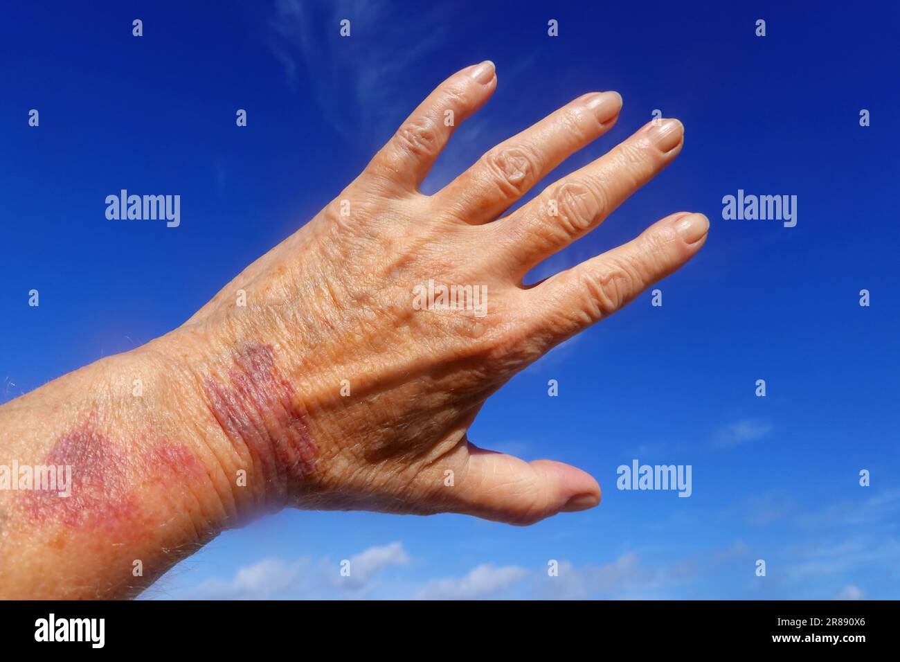Porpora cutanea immagini e fotografie stock ad alta risoluzione - Alamy