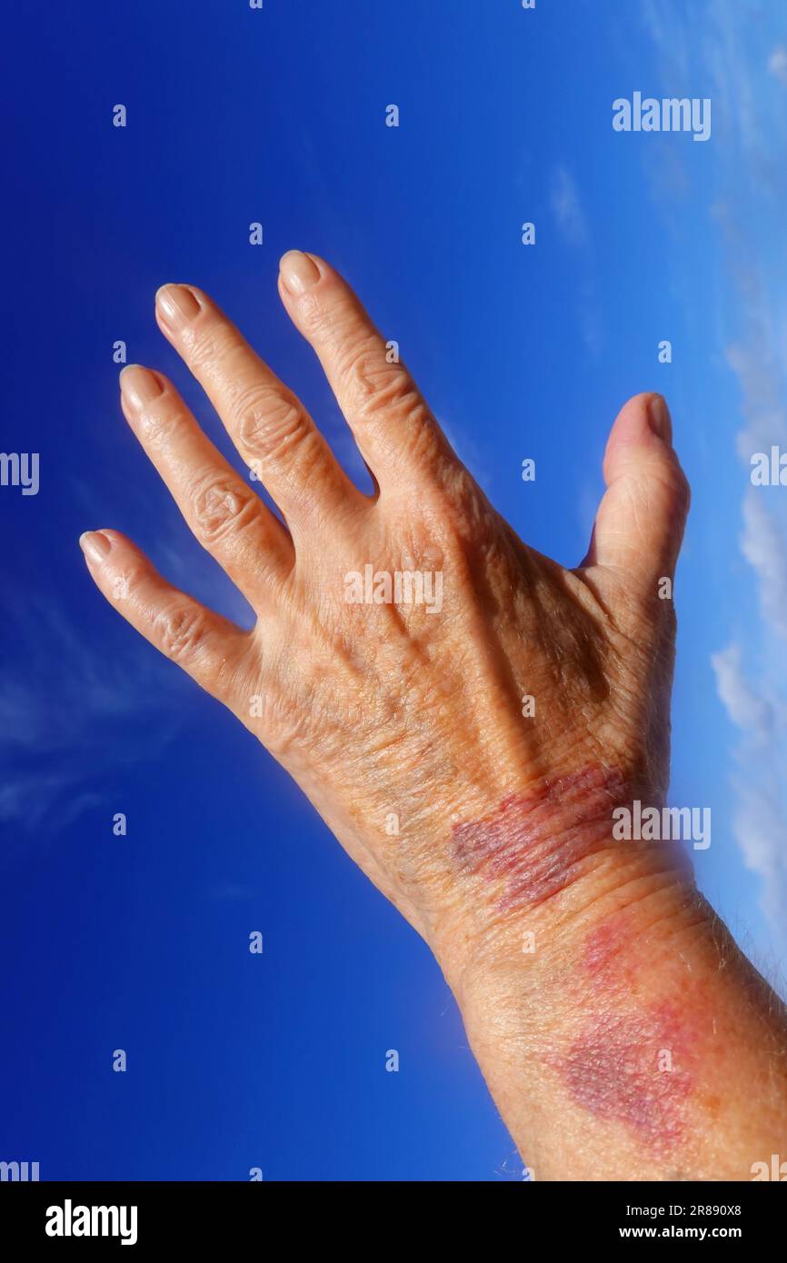 Porpora cutanea immagini e fotografie stock ad alta risoluzione - Alamy