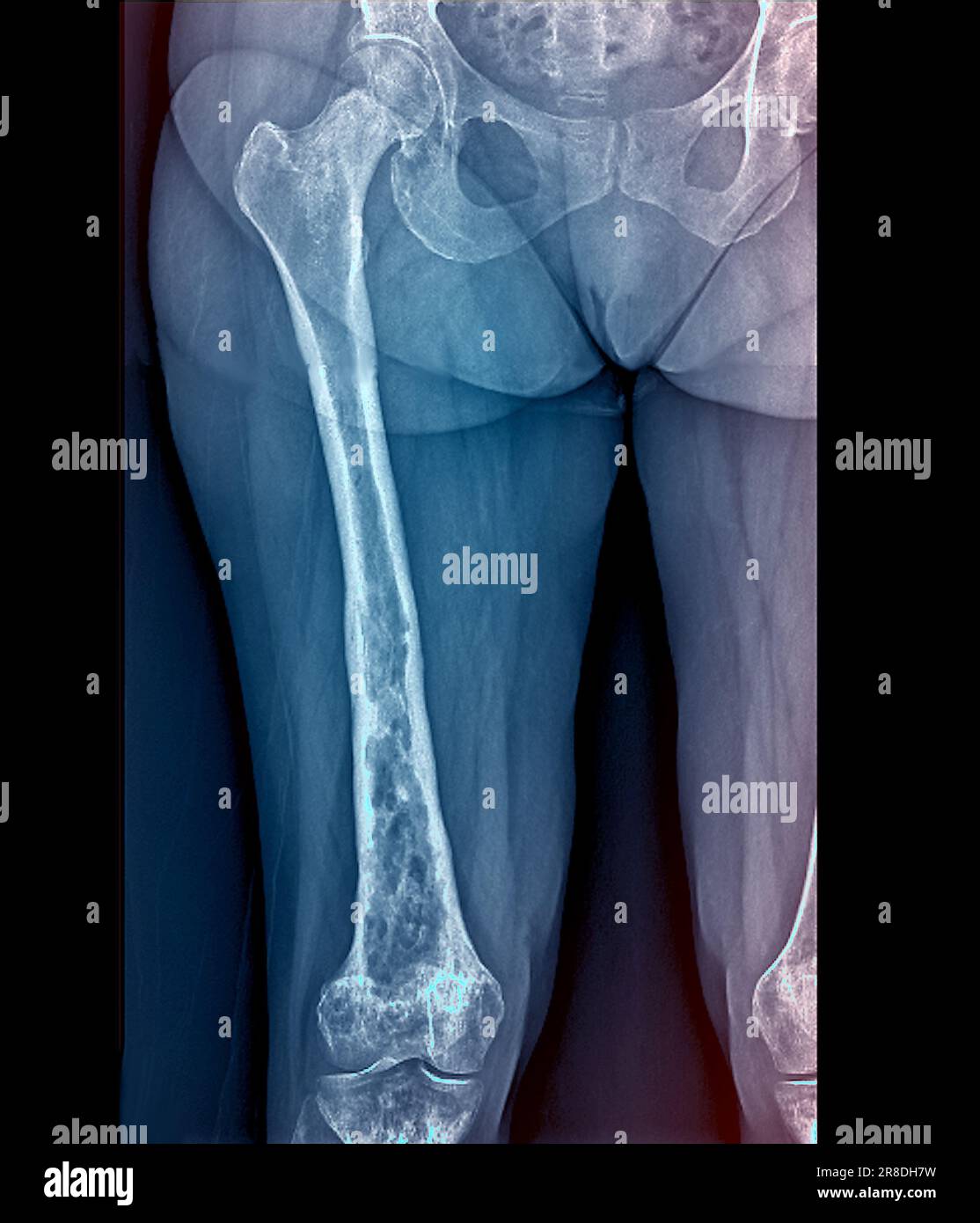 Radiografia colorata delle lesioni nel femore (osso della coscia) di ...