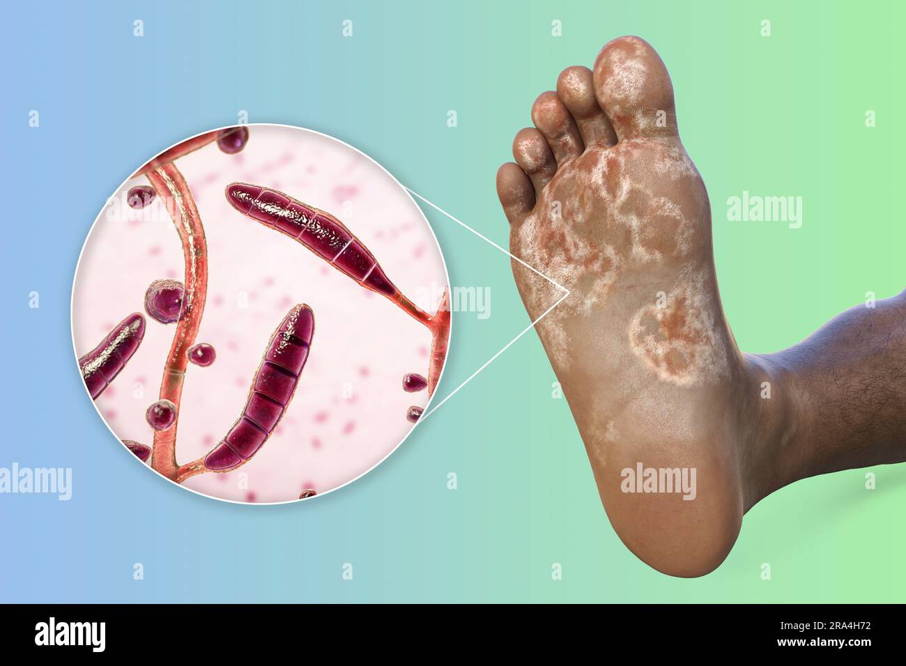 Tinea rubrum immagini e fotografie stock ad alta risoluzione - Alamy