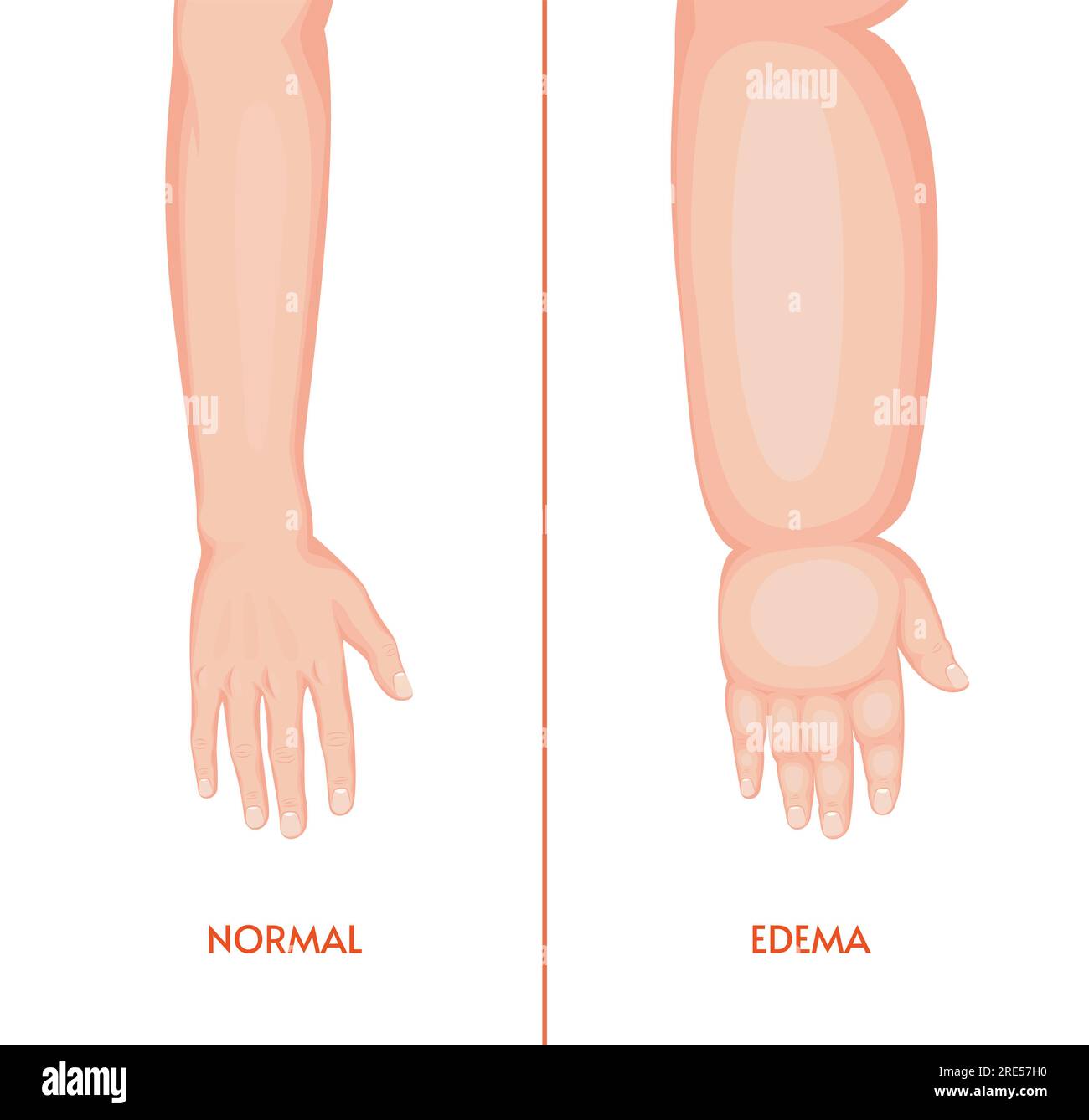 Lymph edema immagini e fotografie stock ad alta risoluzione - Alamy