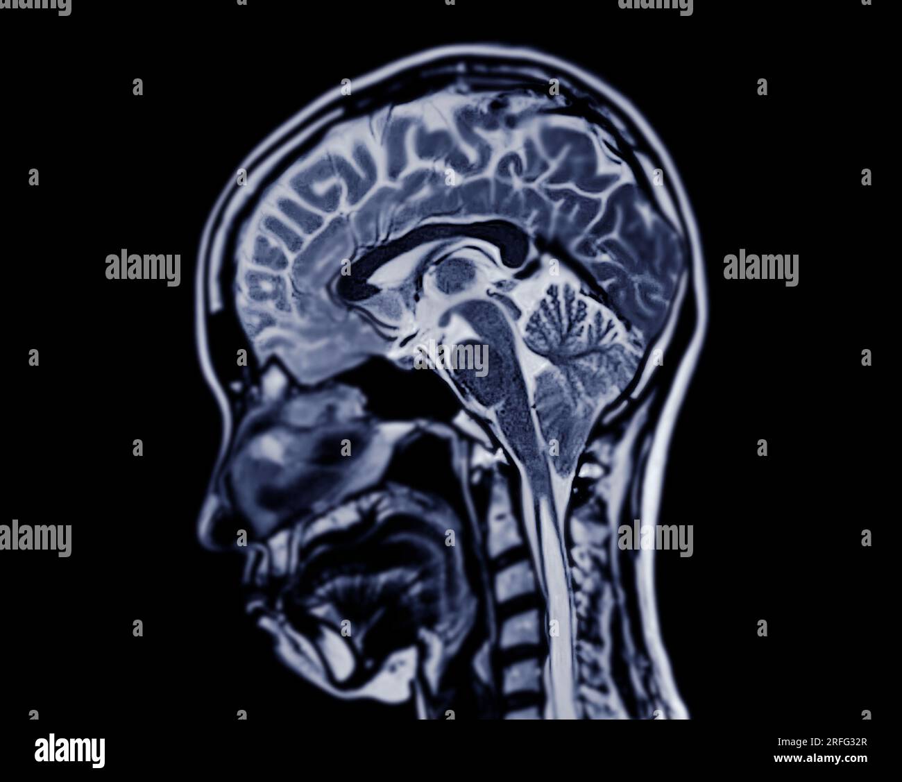 MRI cervello scansione piano sagittale per rilevare le malattie ...