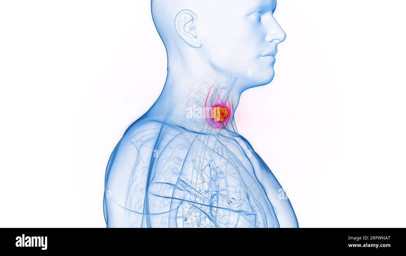 Cisti tiroidea immagini e fotografie stock ad alta risoluzione - Alamy