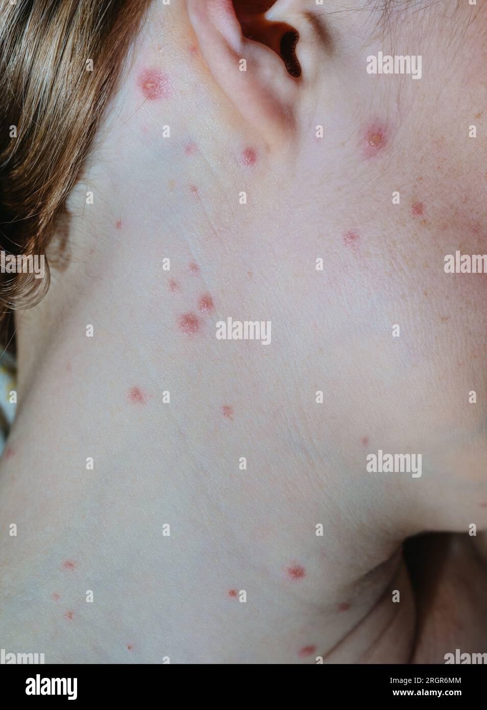 Donna con eruzione cutanea immagini e fotografie stock ad alta ...
