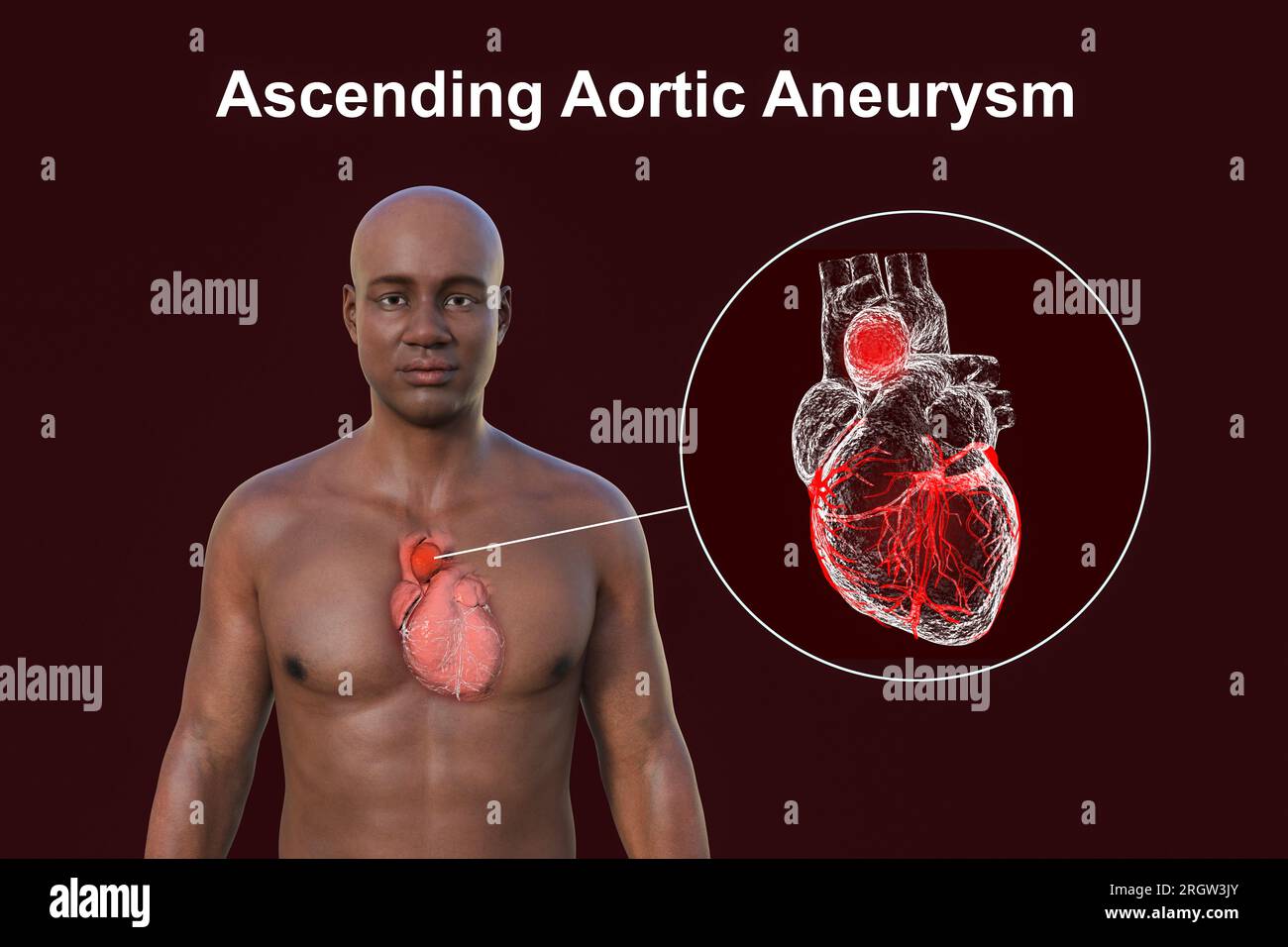 Aortic aneurysm immagini e fotografie stock ad alta risoluzione - Alamy