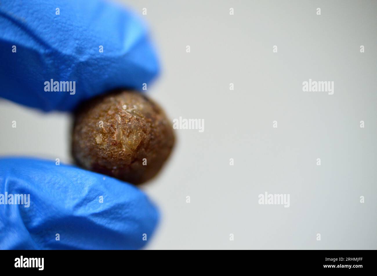 Calcoli biliari grandi rimossi chirurgicamente dopo colecistectomia ...