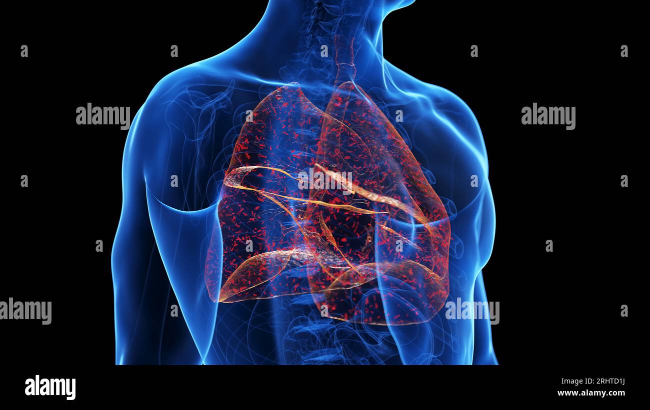 Fibrosi polmonare 3d immagini e fotografie stock ad alta risoluzione ...