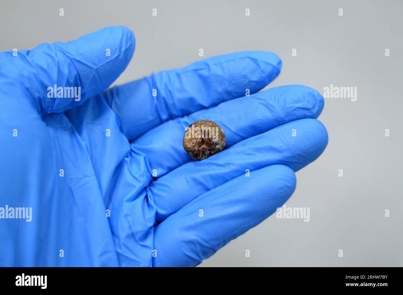 Calcoli biliari grandi rimossi chirurgicamente dopo colecistectomia ...