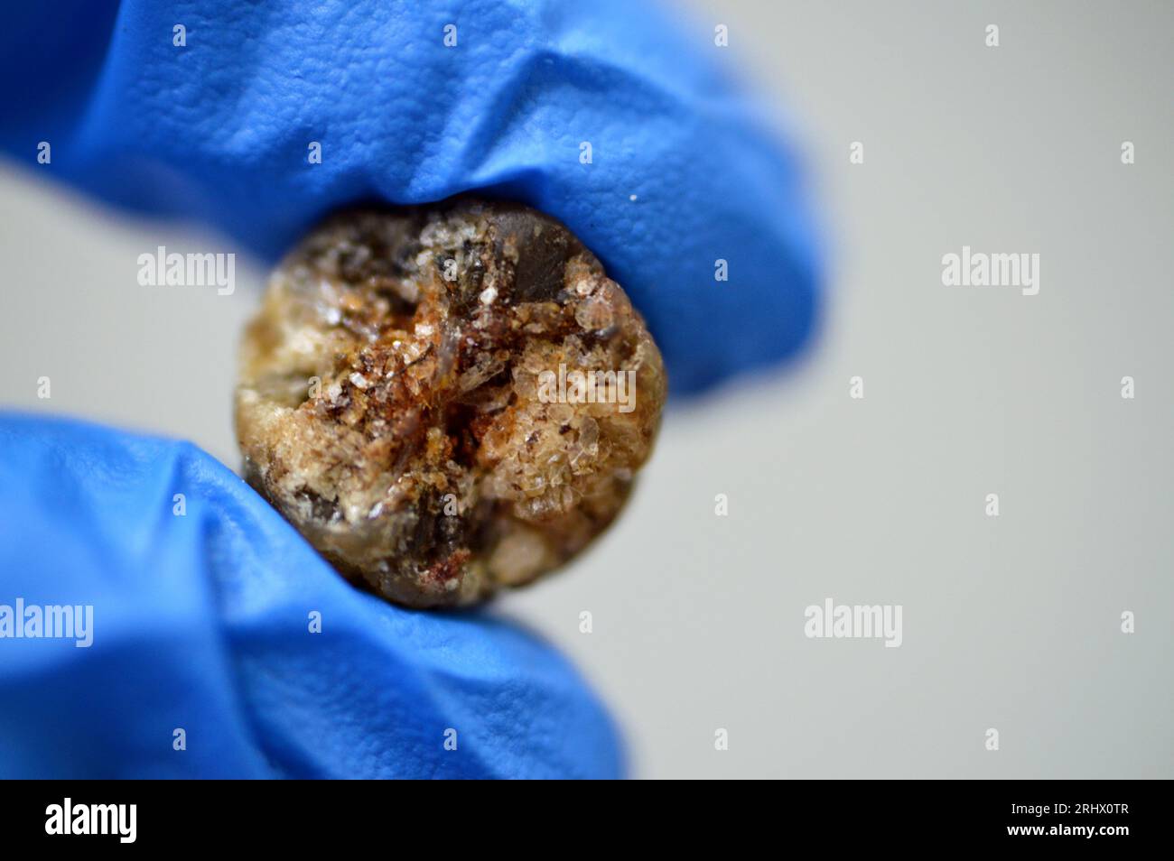 Calcoli biliari grandi rimossi chirurgicamente dopo colecistectomia ...