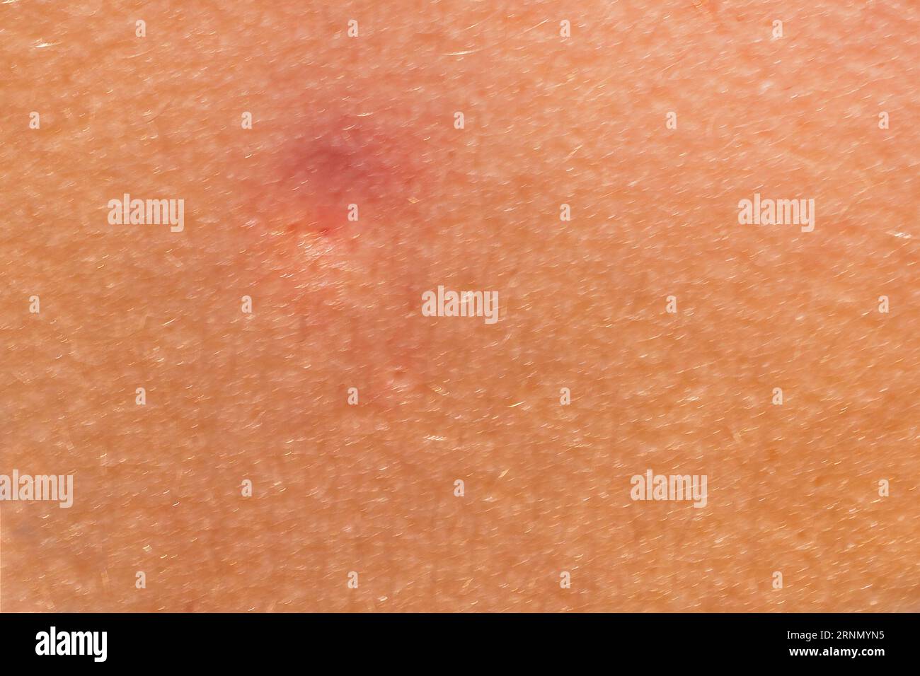 Gestione dei sintomi allergici immagini e fotografie stock ad alta ...