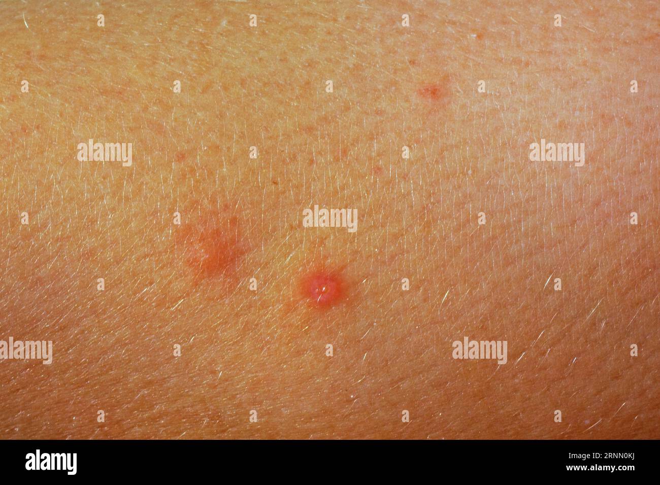 Gestione dei sintomi allergici immagini e fotografie stock ad alta risoluzione - Alamy