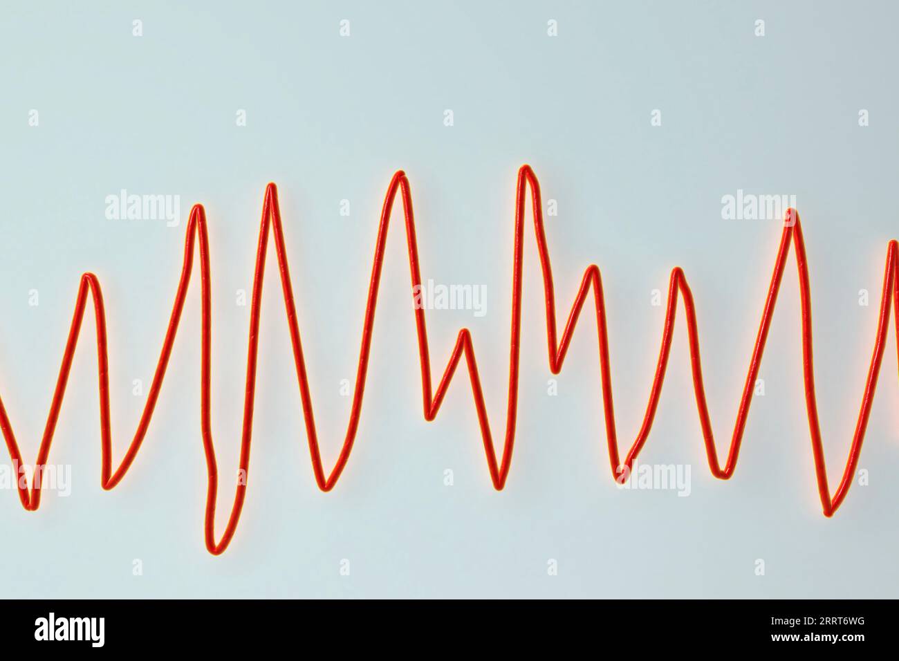 Torsioni di punta ritmo del battito cardiaco, illustrazione Foto stock ...