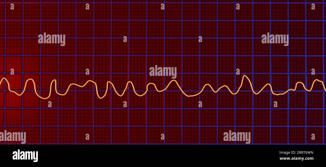 Immagine di un elettrocardiogramma (ECG) che mostra il ritmo caotico ...