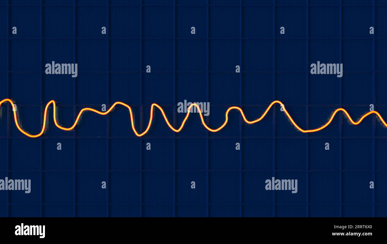 Fibrillazione ventricolare ritmo cardiaco, illustrazione Foto stock - Alamy