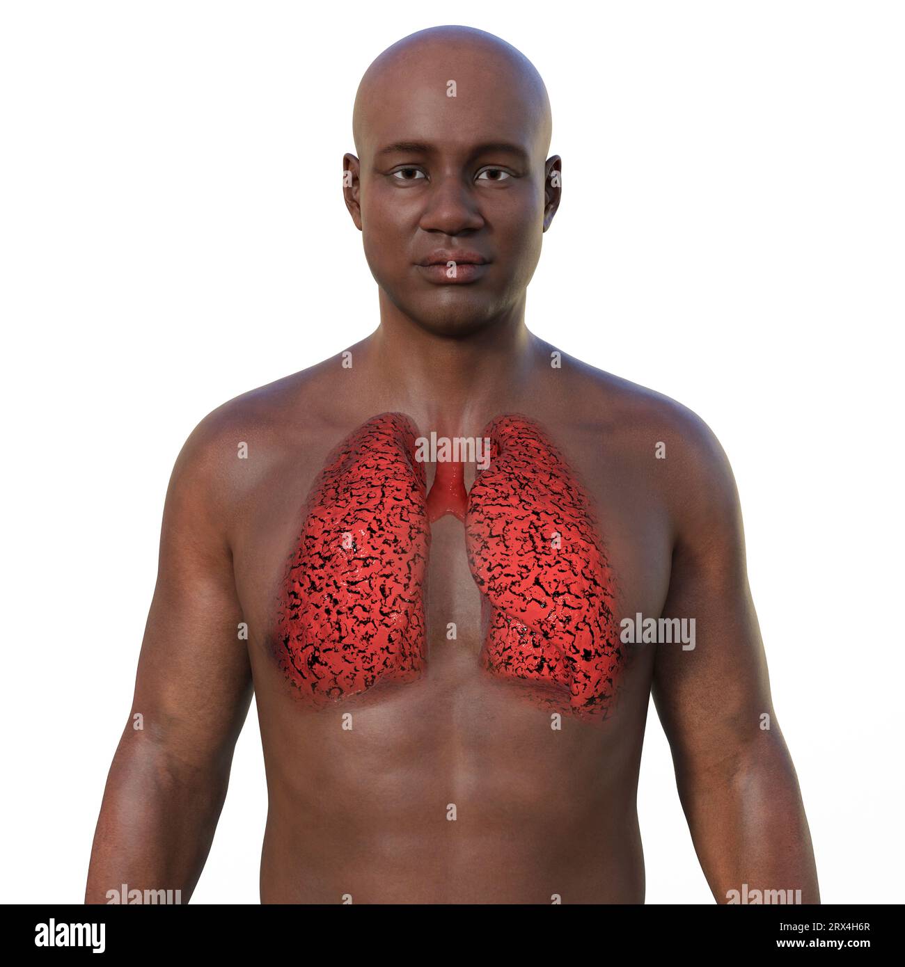 Disturbi del sistema respiratorio del fumo sanitario immagini e fotografie stock ad alta ...