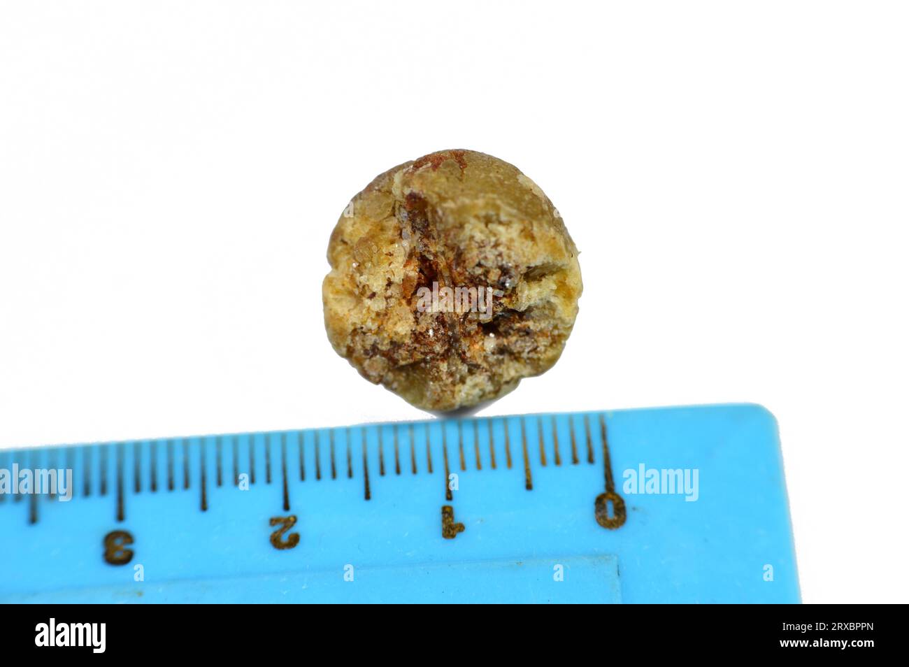 Calcoli biliari grandi rimossi chirurgicamente dopo colecistectomia ...