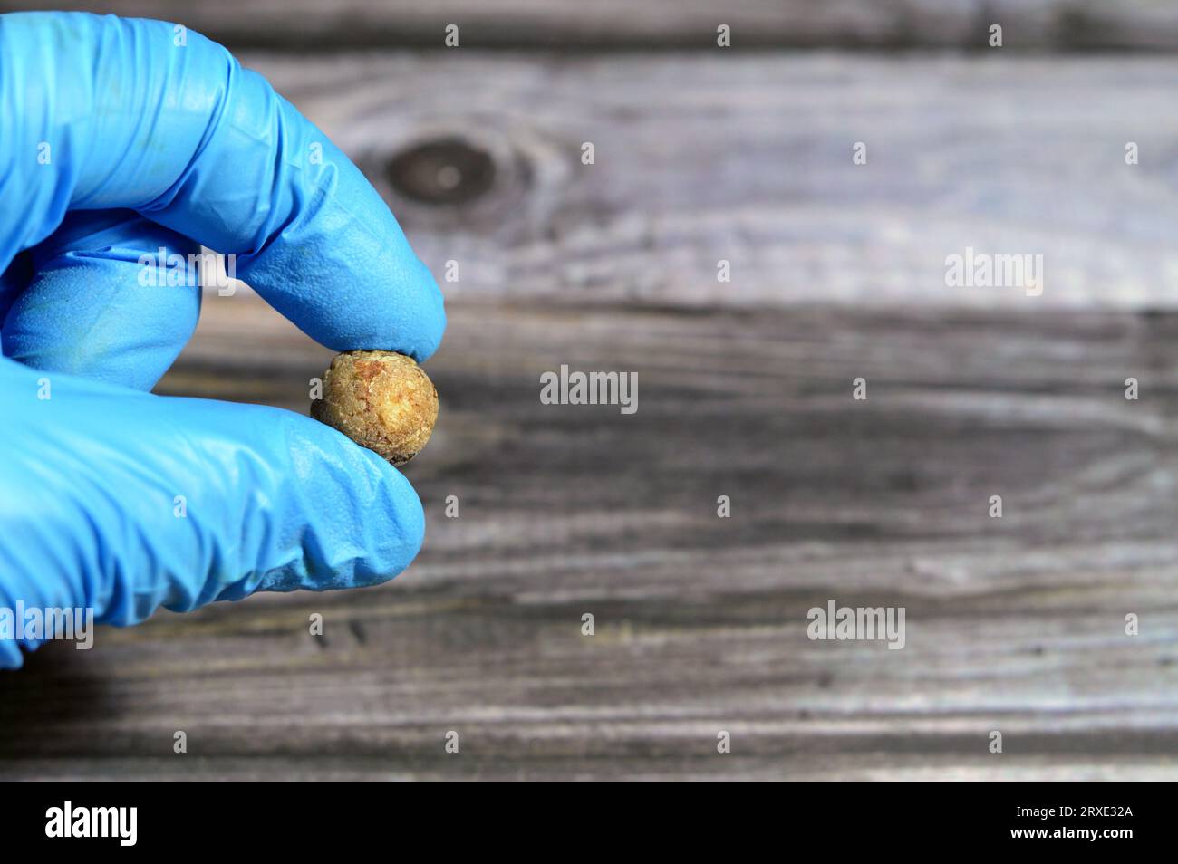 Calcoli biliari grandi rimossi chirurgicamente dopo colecistectomia ...