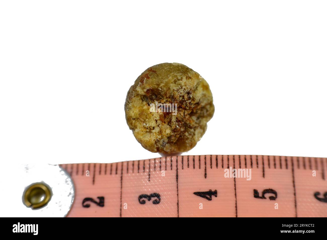 Calcoli biliari grandi rimossi chirurgicamente dopo colecistectomia ...