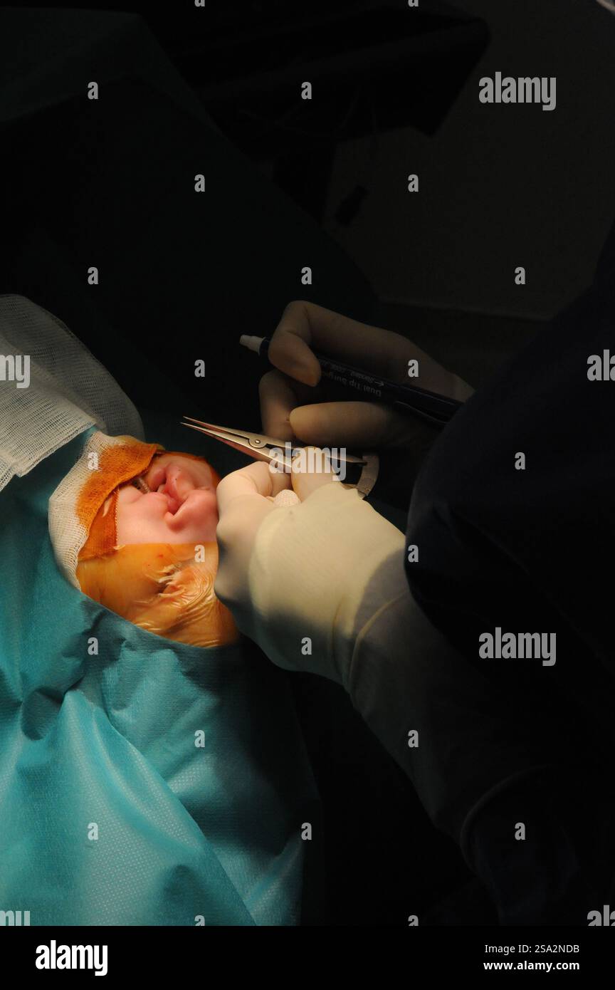 Il palato o harelip è una malformazione congenita che verrà corretta ...