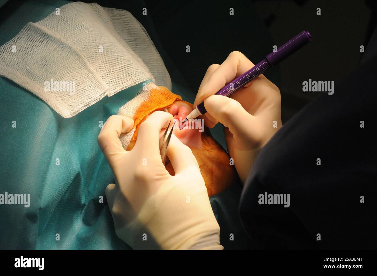 Il palato o harelip è una malformazione congenita che verrà corretta ...