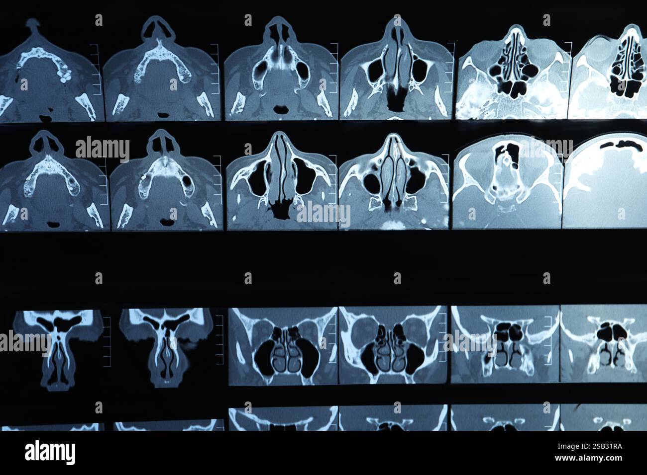 Anatomia del naso e seni paranasali immagini e fotografie stock ad alta ...