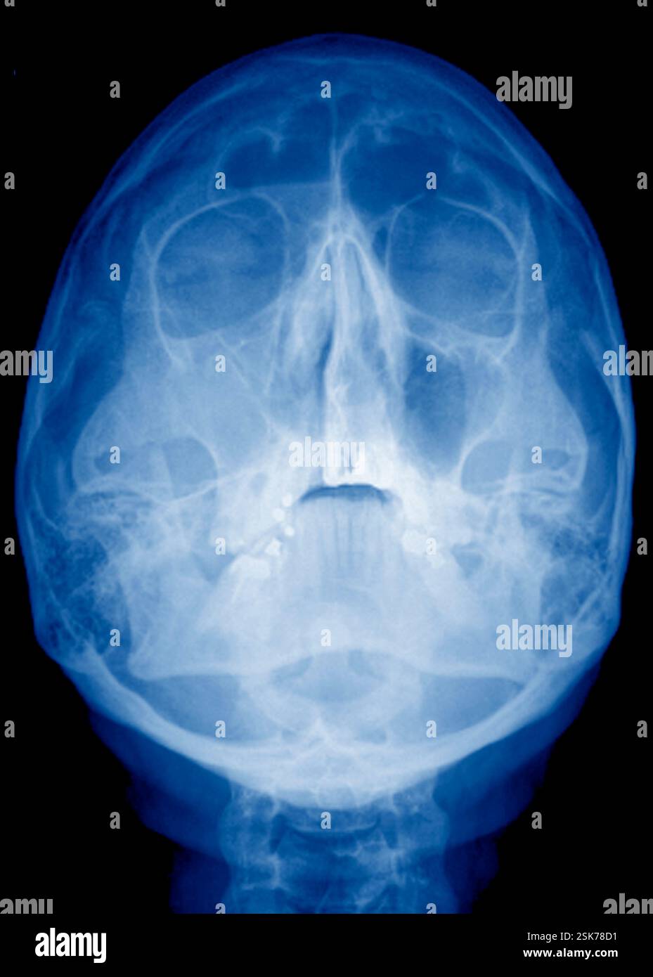 Radiografia colorata (vista frontale obliqua) del cranio di una ...