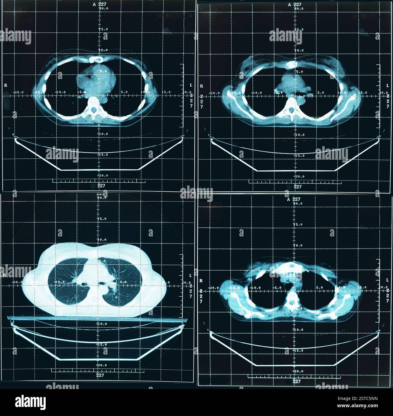 Anatomía del tórax humano immagini e fotografie stock ad alta ...