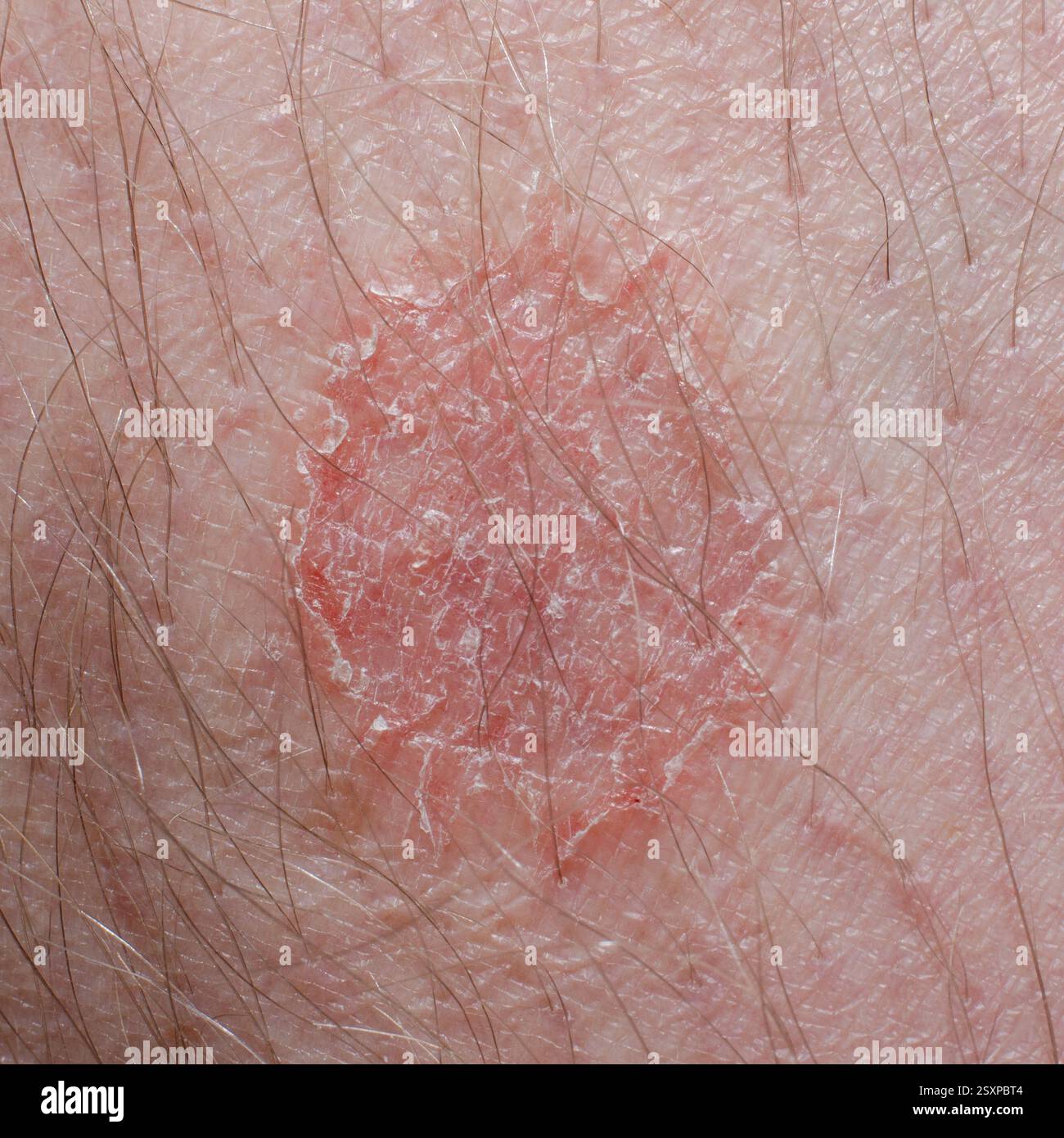 Itchy skin rash immagini e fotografie stock ad alta risoluzione - Alamy
