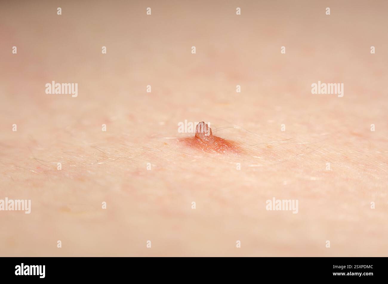 Pelle umana microscopio immagini e fotografie stock ad alta risoluzione ...