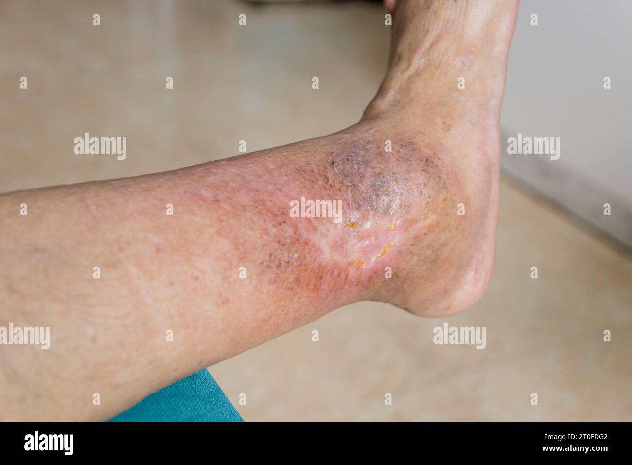 Ulcera venosa cronica immagini e fotografie stock ad alta risoluzione ...